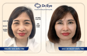 Các loại mí mắt phổ biến tại Việt Nam có thể bạn chưa biết